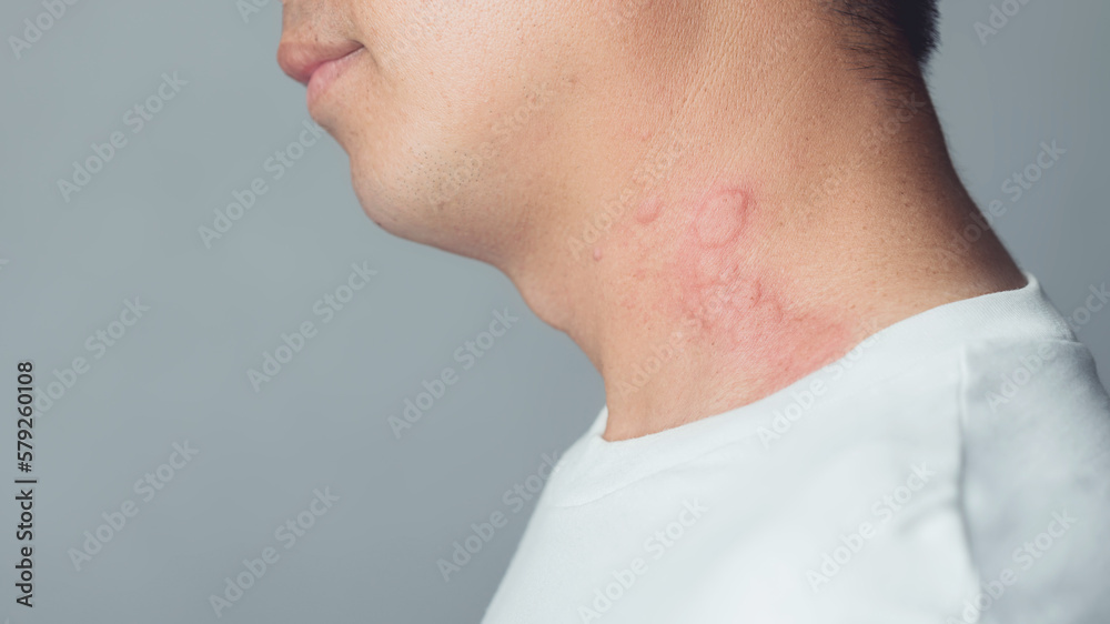 Man having red papules, itchy rash and scratching his neck. Skin ...