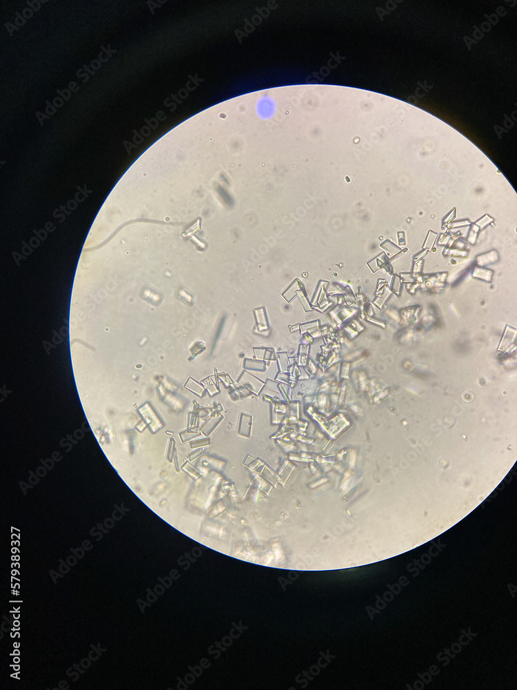 Foto de Microscopic view of struvite crystals from urinary sediment ...