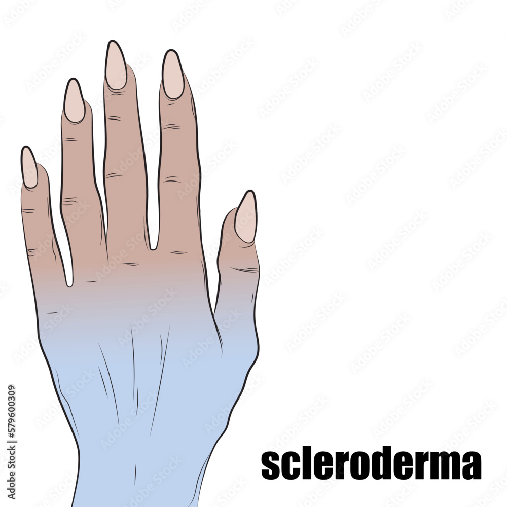 Vetor de Scleroderma, a chronic disease of women, makes the skin thick, causes inflammation in ...