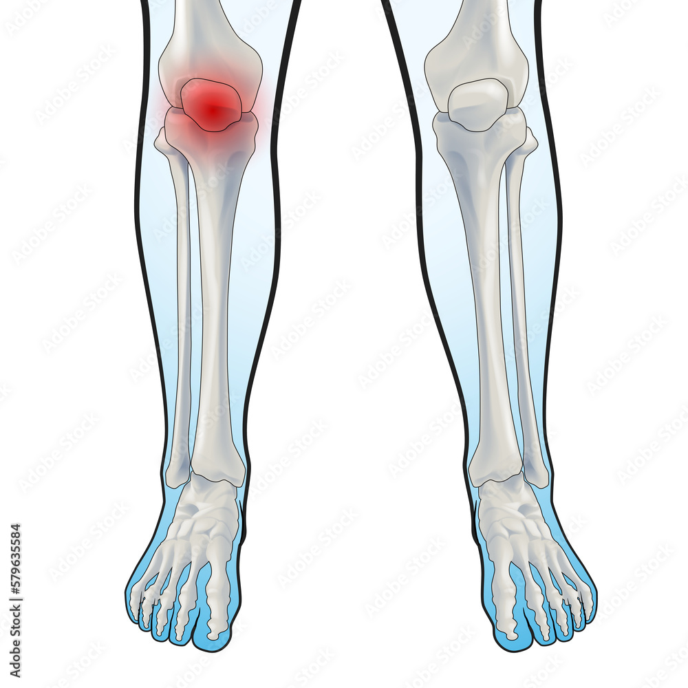 Educational medical illustration of leg bones and horns showing pain ...