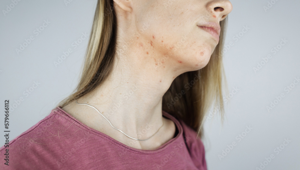 Girl shows acne on her face. Acne on the neck. Demodicosis on the chin ...