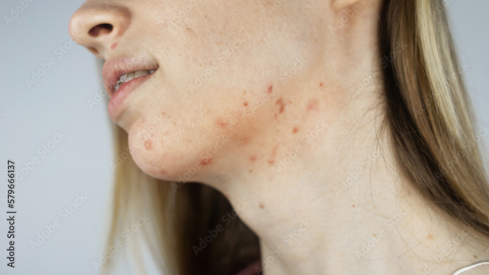 Girl shows acne on her face. Acne on the neck. Demodicosis on the chin ...
