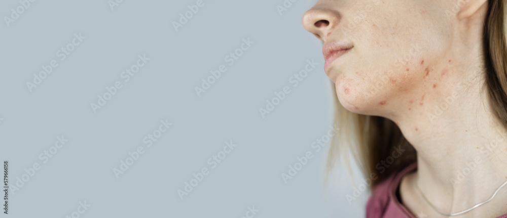 Foto de Girl shows acne on her face. Acne on the neck. Demodicosis on ...