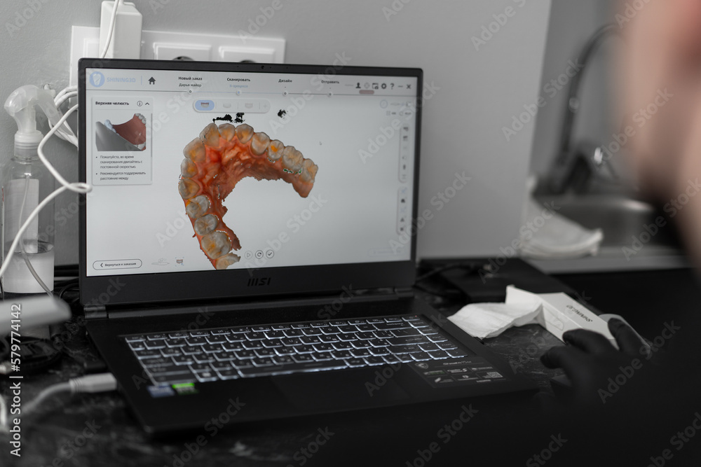 Dentistry 3D scan of the patient's teeth on the screen Stock Photo ...