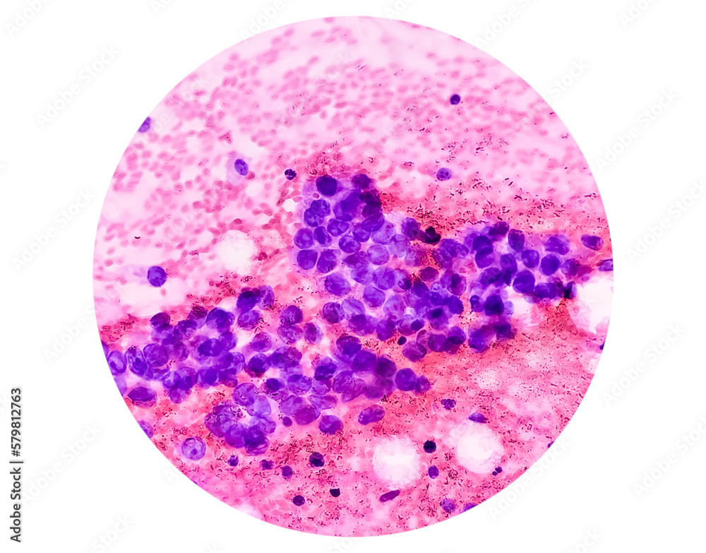 Foto de Photomicrograph of fine needle aspiration (FNA) cytology of a ...