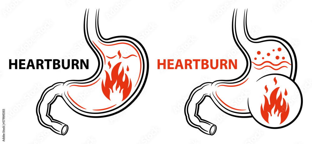 Heartburn, stomach burning fire pain, gastritis, GERD gastroesophageal ...