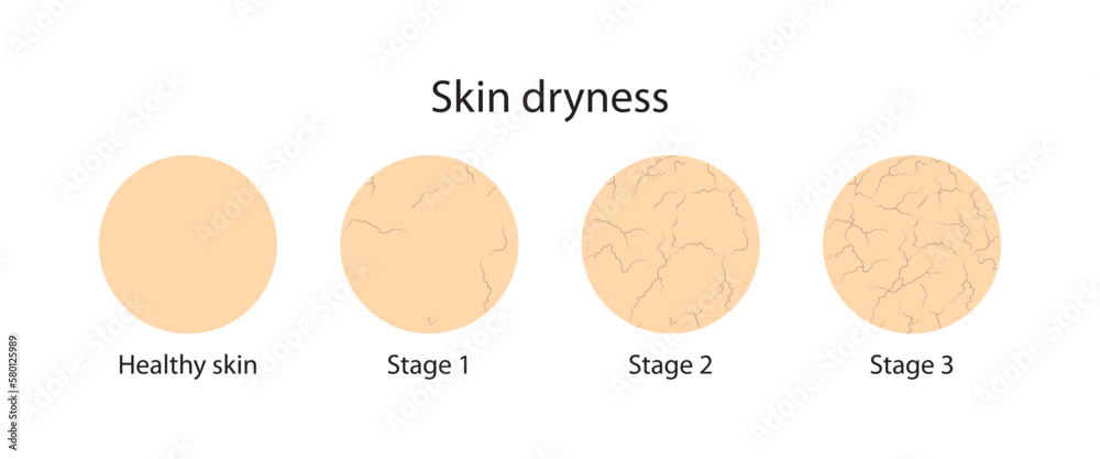 Skin dryness Stock Vector | Adobe Stock
