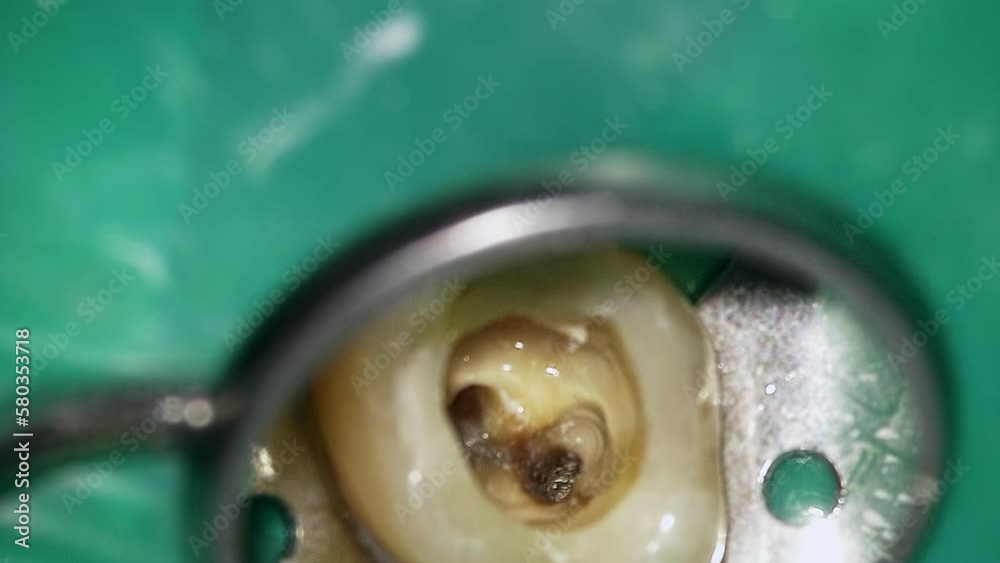 Vidéo Stock Dentist is fulling hole in tooth with water to clean cavity ...