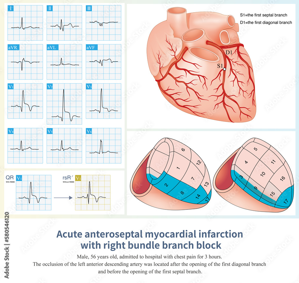 Counterclockwise rotation is a common ECG phenomenon, which is partly a ...