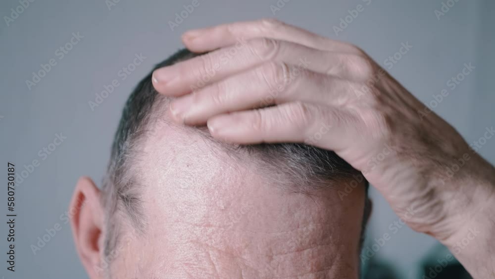 Elderly Man with Hair Loss Problems Touches his Balding Gray Head with ...