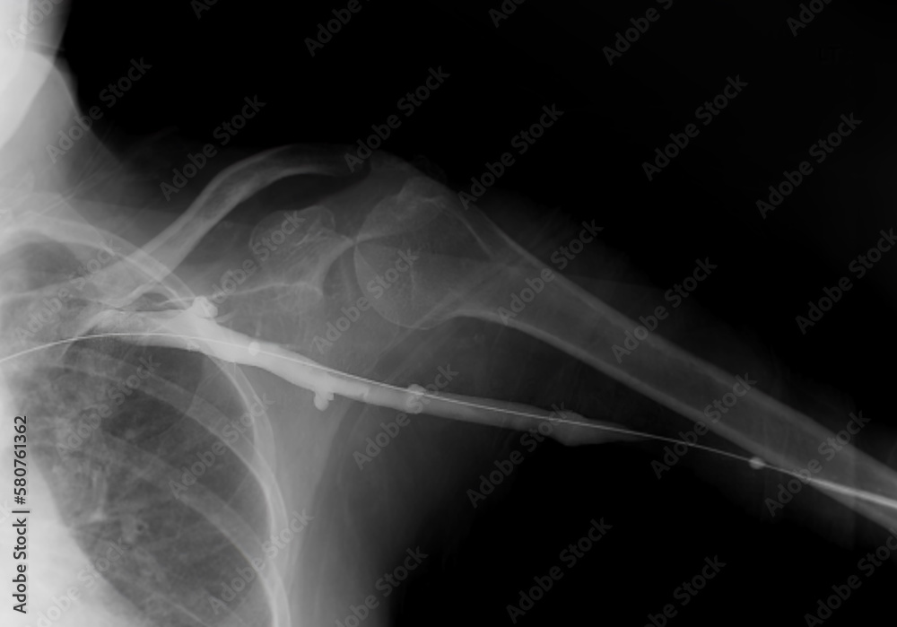 Foto de Image of Angioplasty, balloon angioplasty and percutaneous ...