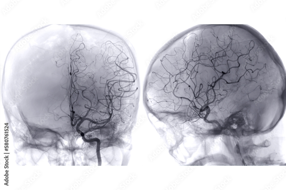 Cerebral angiography image from Fluoroscopy in intervention radiology ...