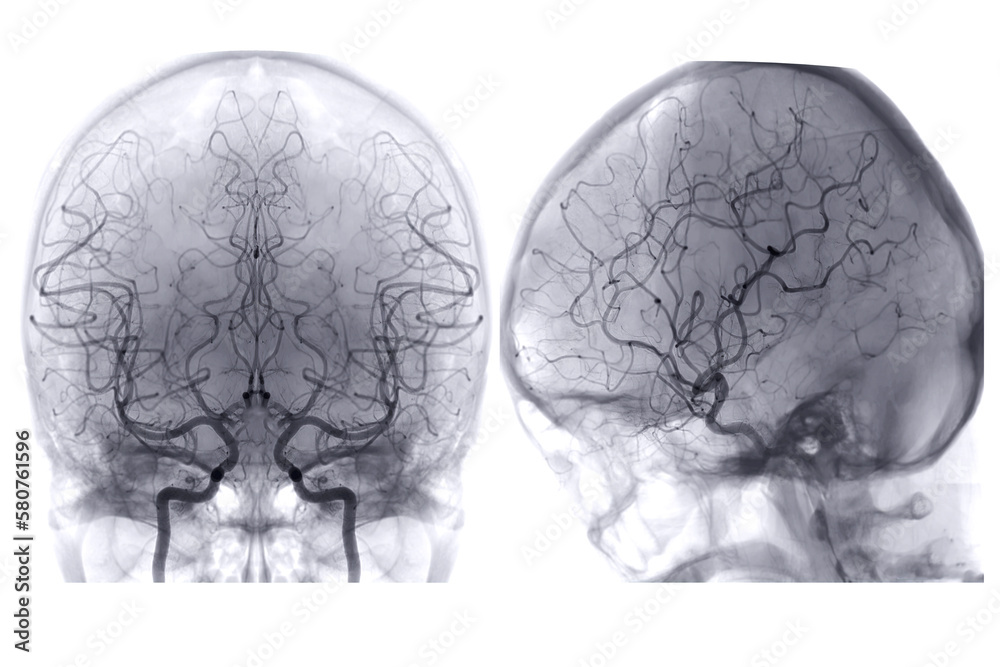 Cerebral angiography image from Fluoroscopy in intervention radiology ...