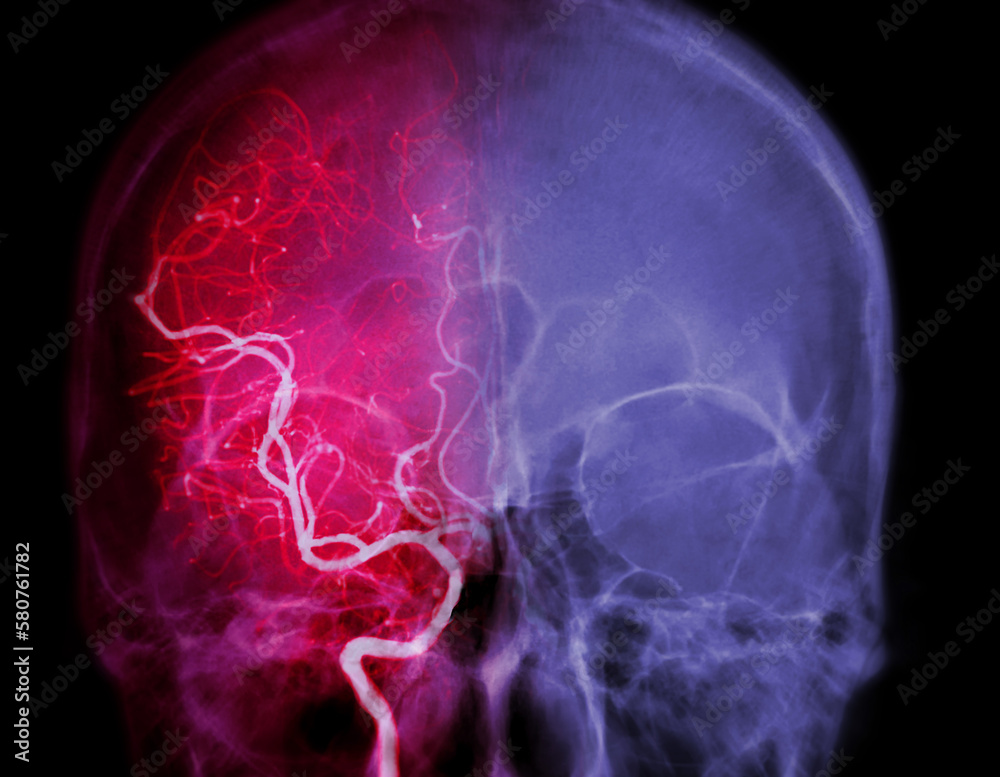 Poster Cerebral angiography image from Fluoroscopy in intervention ...
