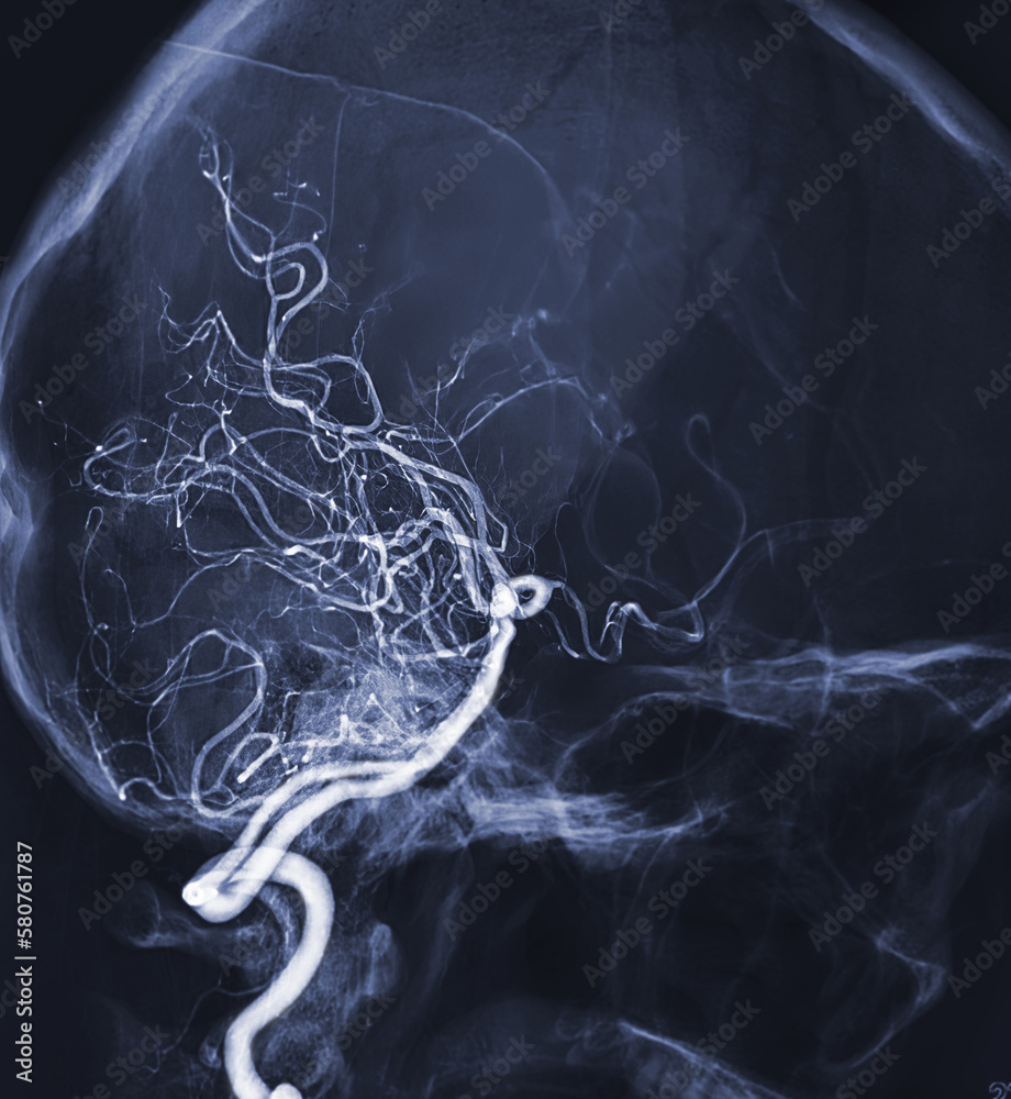 Cerebral angiography image from Fluoroscopy in intervention radiology ...