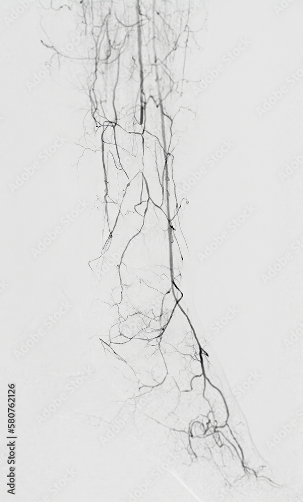 Femoral artery angiogram or angiography at lower extremity area. Stock ...