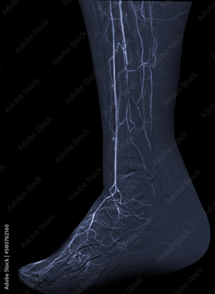 Femoral artery angiogram or angiography at lower extremity area. Stock ...