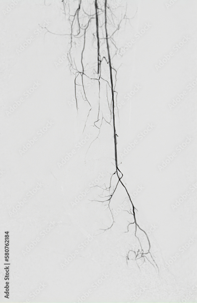 Femoral artery angiogram or angiography at lower extremity area. Stock ...