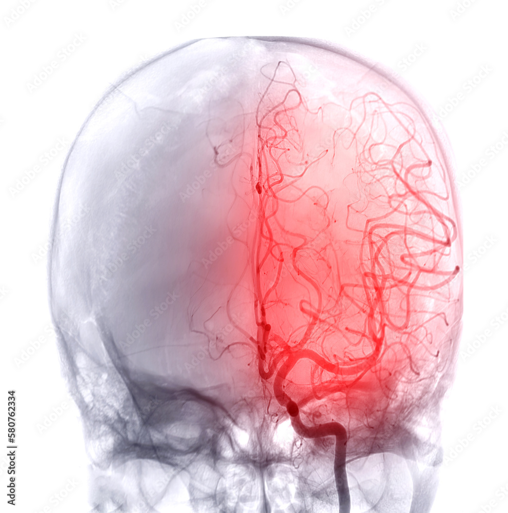 Cerebral angiography image from Fluoroscopy in intervention radiology ...