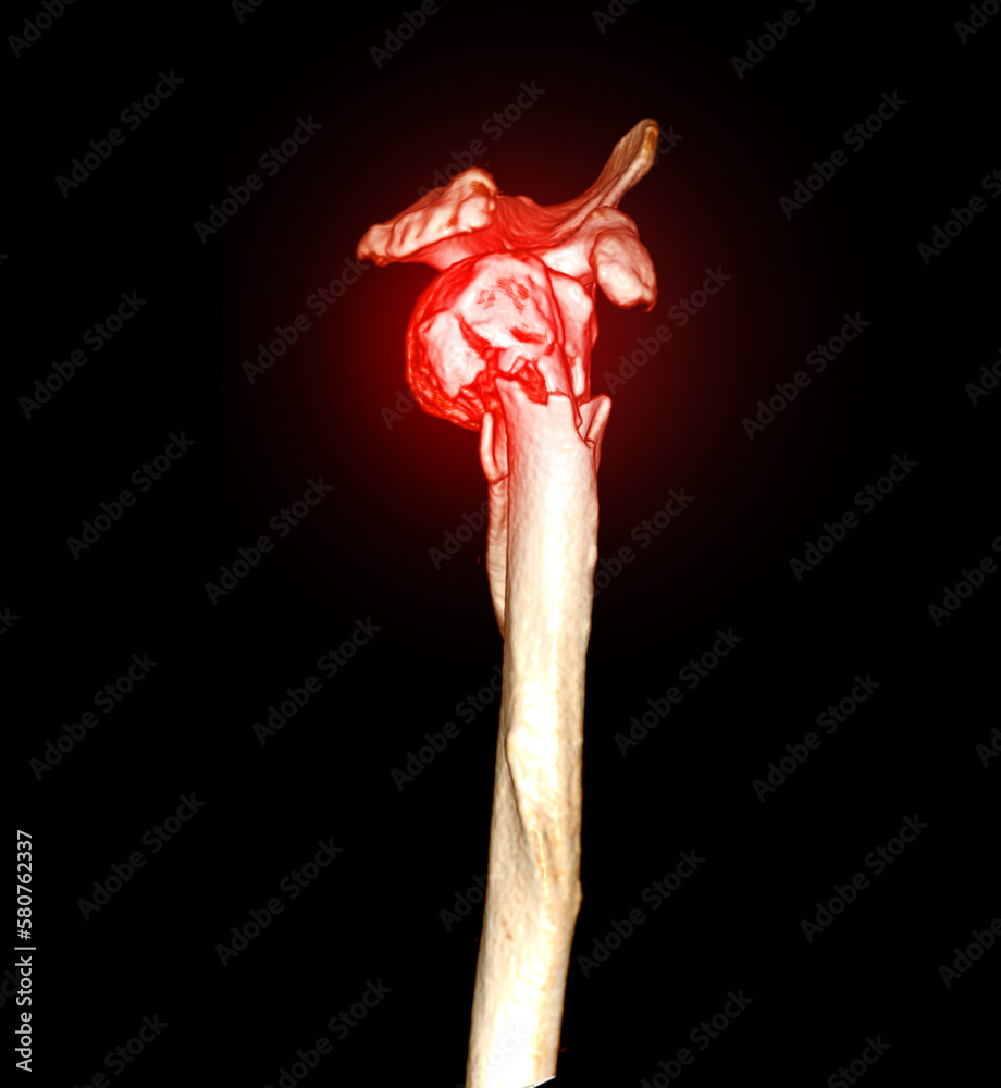 CT scan 3D rendering of Left shoulder showing fracture head of humerus ...