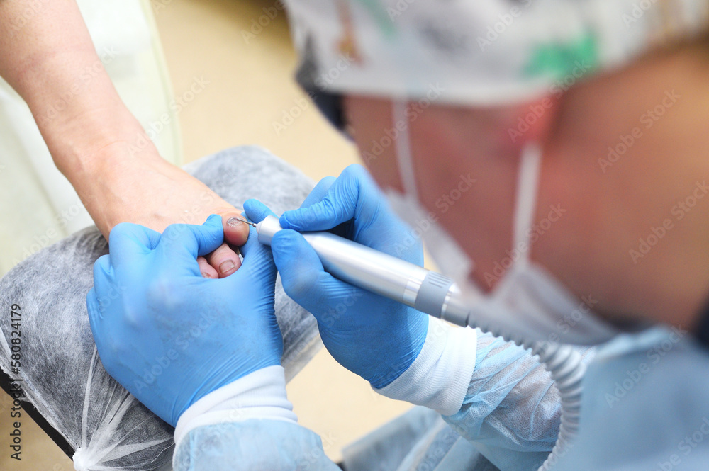 Hardware medical pedicure with a drill for nail files. Onychomycosis ...