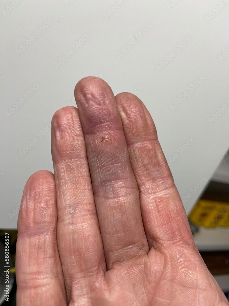 Red swollen cut accident wound on hand with rusty nail infection ...