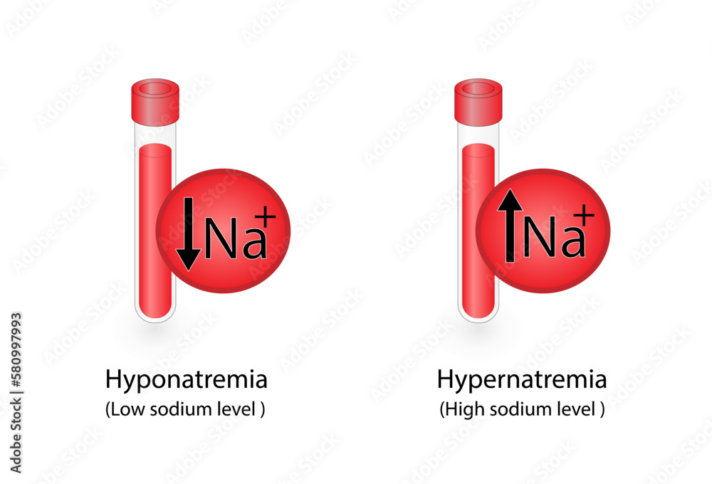 Hypernatremia, high plasma sodium level and Hyponatremia, low plasma ...