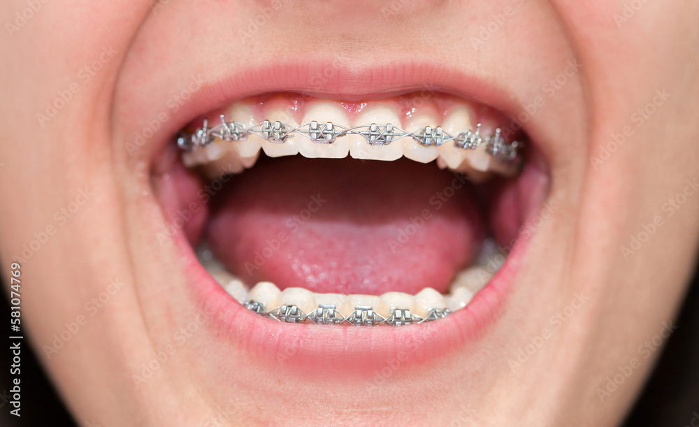 Letter from the orthodontist. Braces and brackets on the teeth are a ...