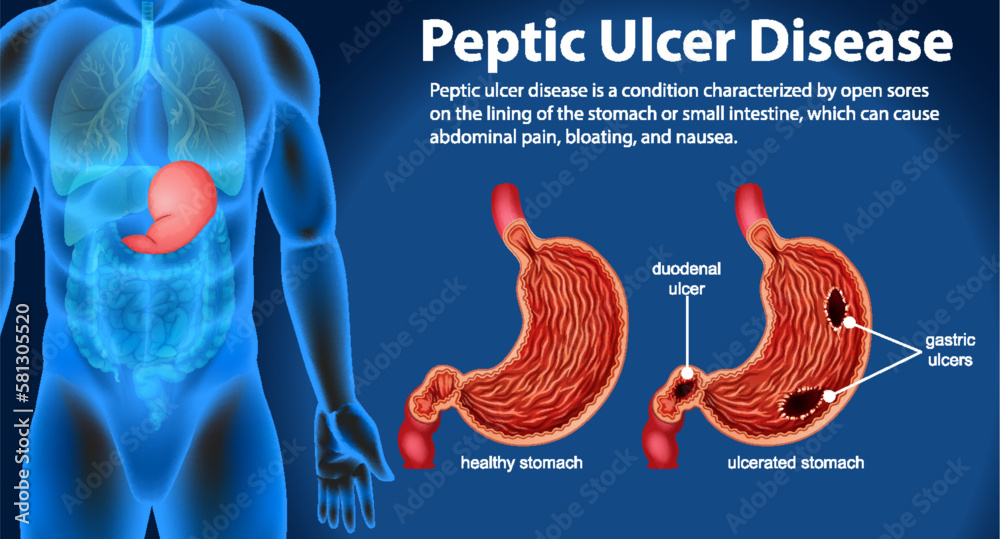 Peptic Ulcer Disease Infographic Stock Vector | Adobe Stock