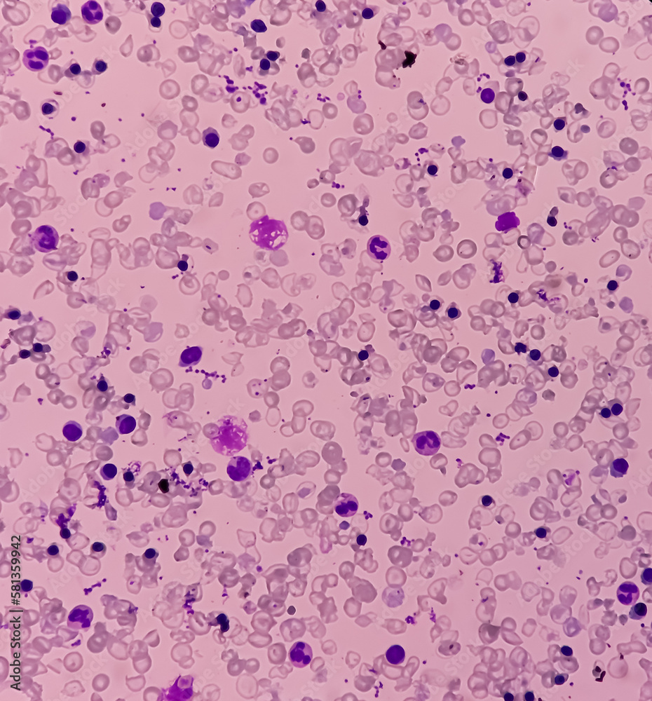 Hereditary hemolytic anemia. Hemoglobin E (HbE) disease. Smear show 90 ...