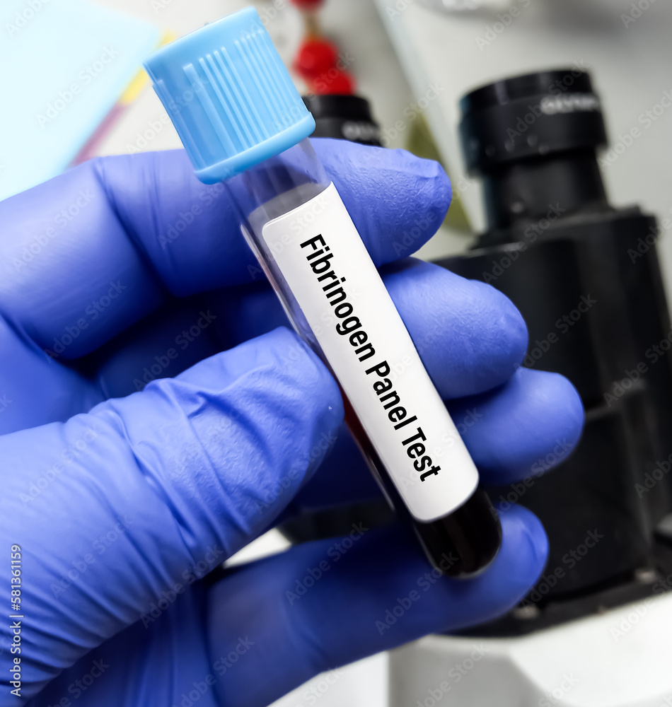 Foto de Test tube with blood sample for fibrinogen panel test, to ...
