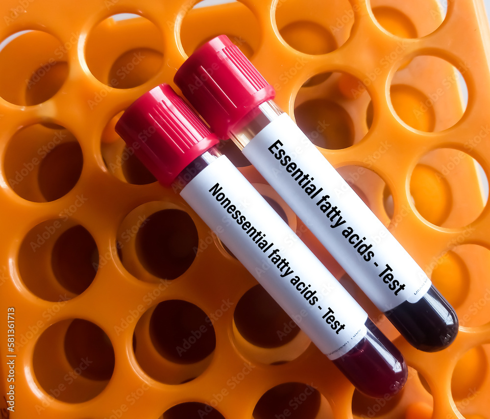 Blood Sample for Fatty acid (Essential and Nonessential) test. to ...