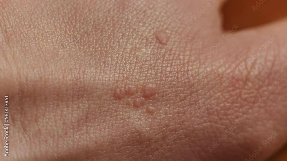Vidéo Stock Close up examination of a wart on the patient's hands with ...