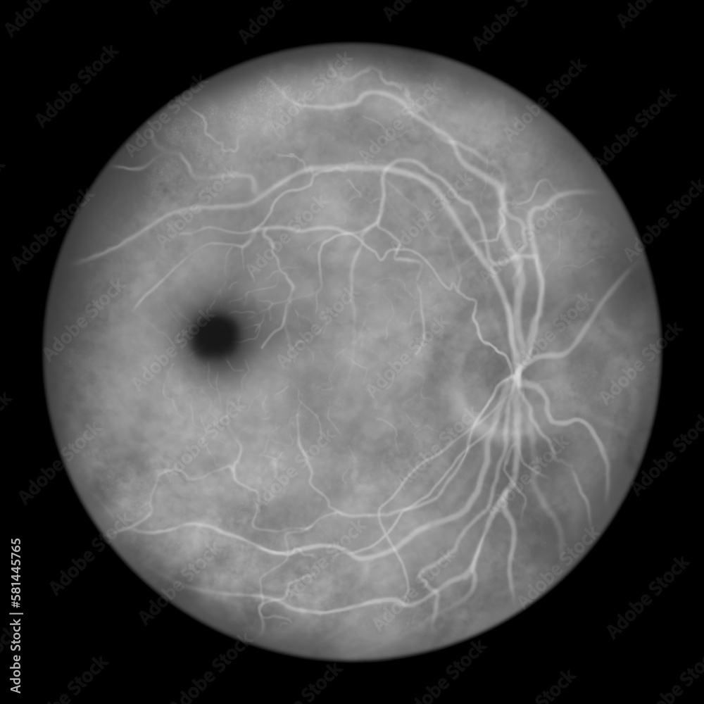 Best vitelliform macular dystrophy, vitelliform stage, classic egg-yolk ...