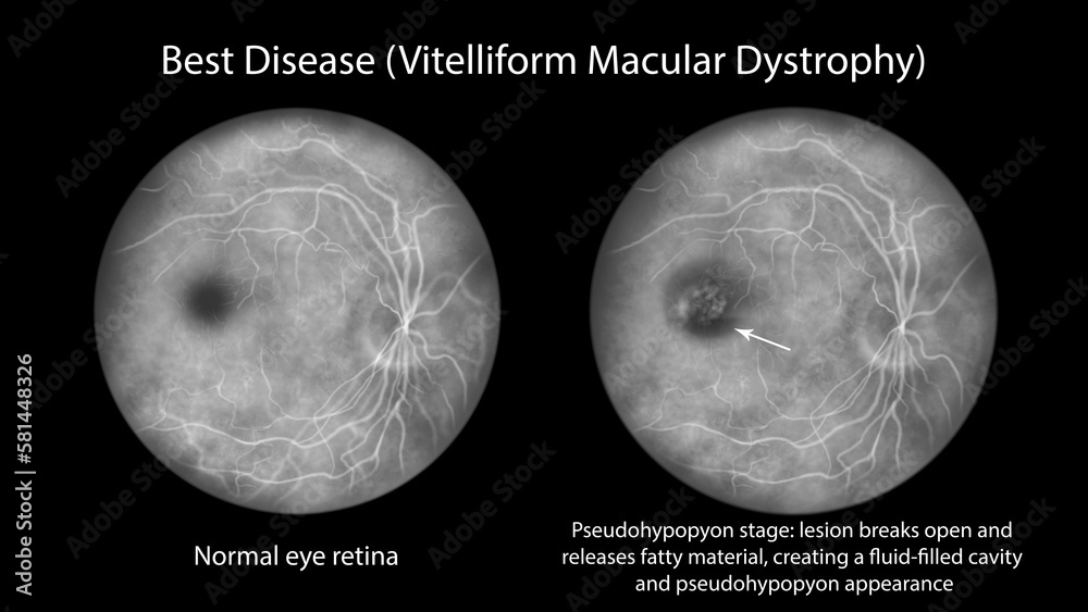 Best disease, an illustration showing normal eye retina and Best ...
