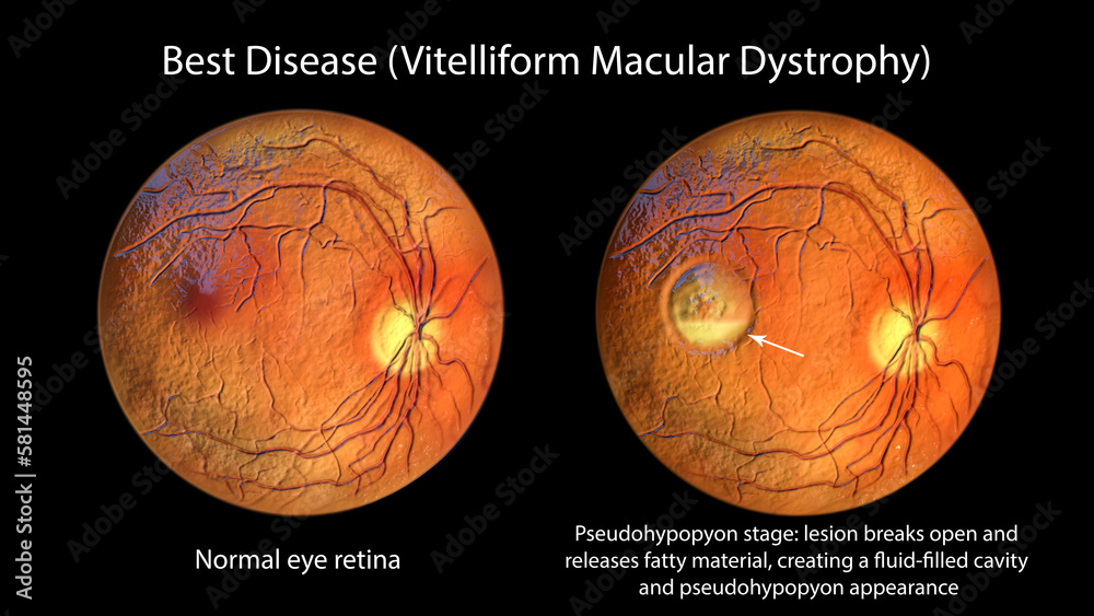 Best disease, 3D illustration showing normal eye retina and Best ...