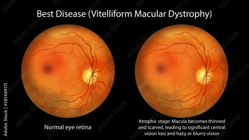 Best disease, an illustration showing normal eye retina and Best ...