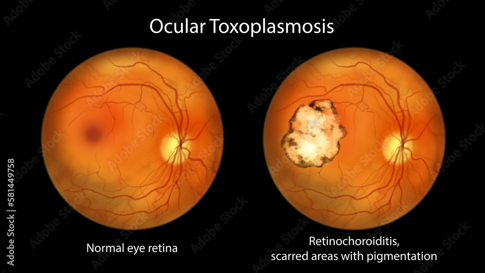 Retinal scar caused by a Toxoplasma gondii infection, or toxoplasmosis ...