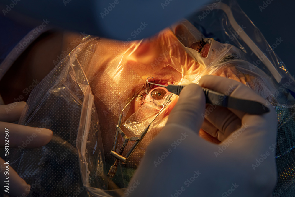 Laser vision correction. A patient and team of surgeons in the ...