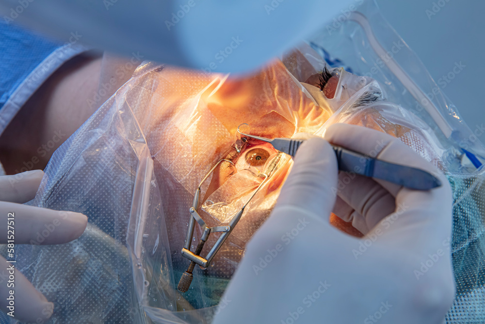 Laser vision correction. A patient and team of surgeons in the ...