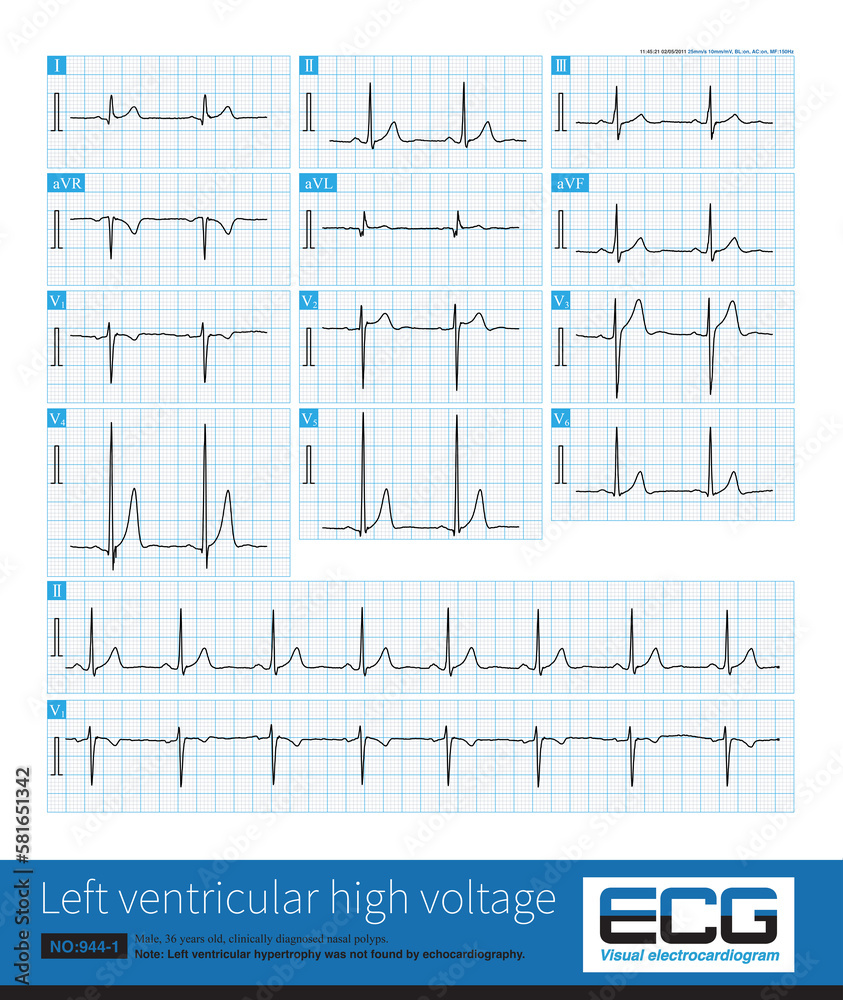 Simple left ventricular high voltage is only an ECG phenomenon. The ...
