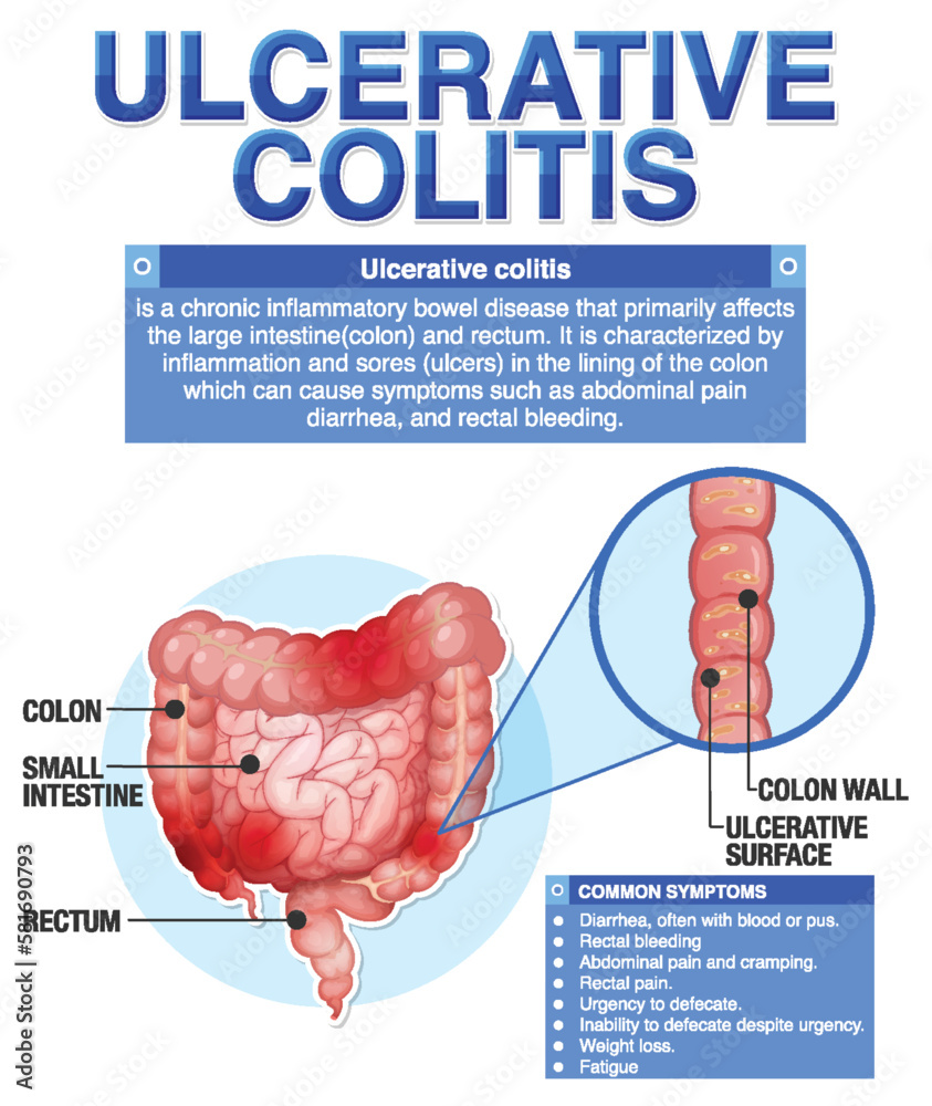 Ulcerative Colitis Symptoms Infographic Stock Vector | Adobe Stock