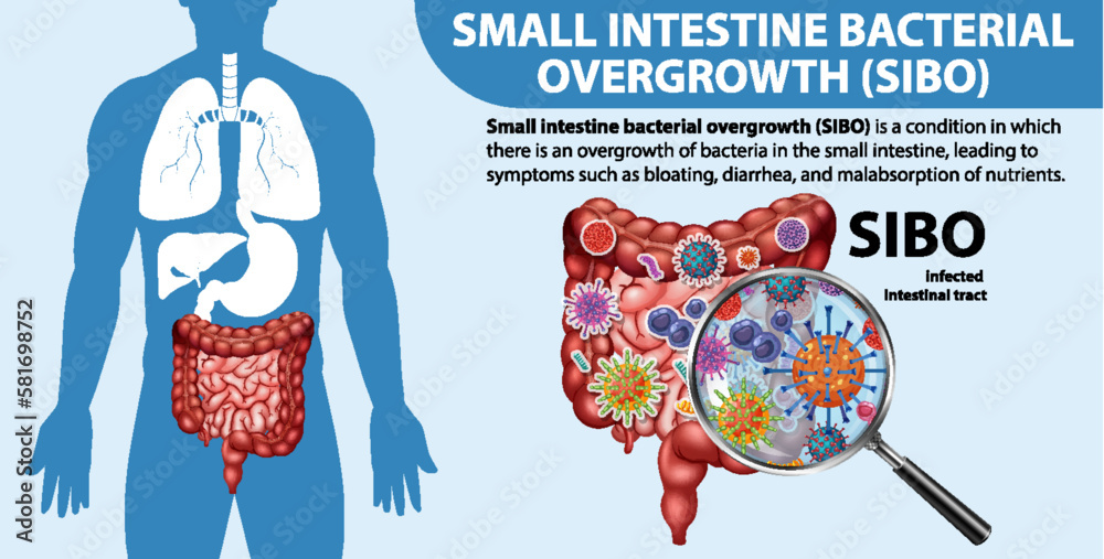 Small Intestine Bacterial Overgrowth (SIBO) Stock Vector | Adobe Stock
