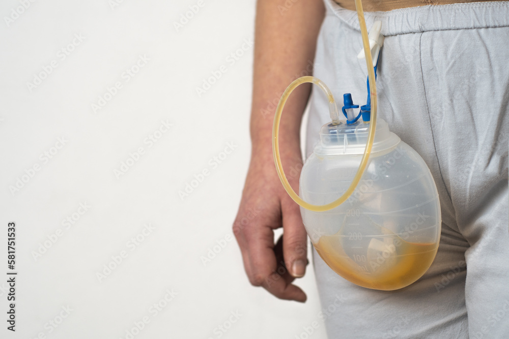 Surgical drainage on a patient filled with drained serous yellow fluid ...