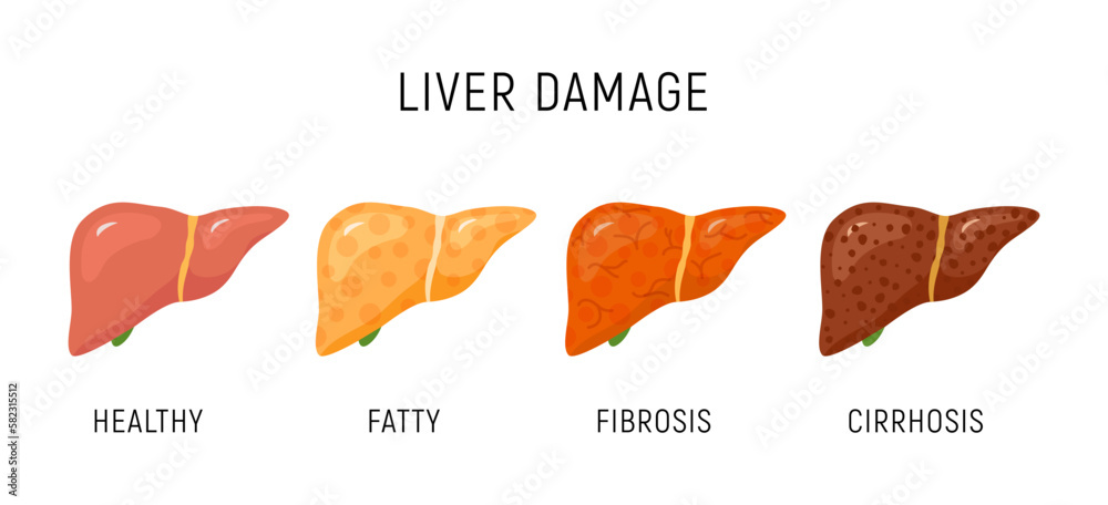 Liver damage infographic diagram cancer disease anatomy. Liver damage ...