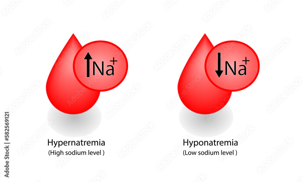 Vetor de Hypernatremia, high plasma sodium level and Hyponatremia, low ...