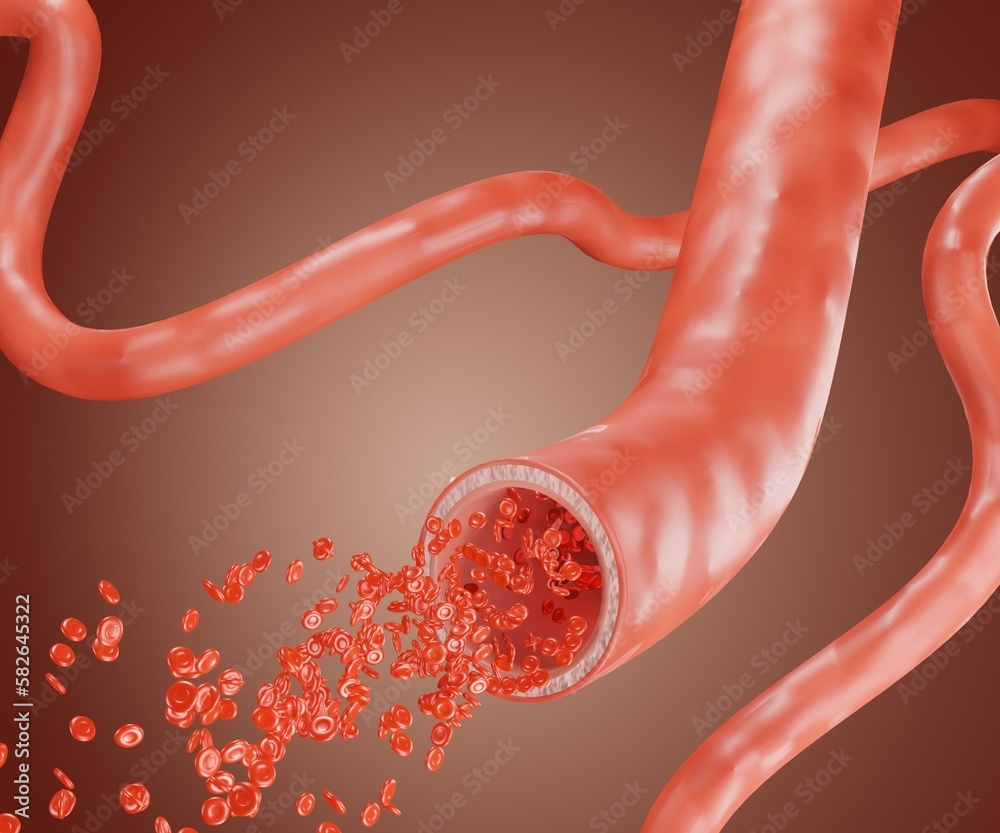 bursting blood vessel and red blood cells scattered in the white ...