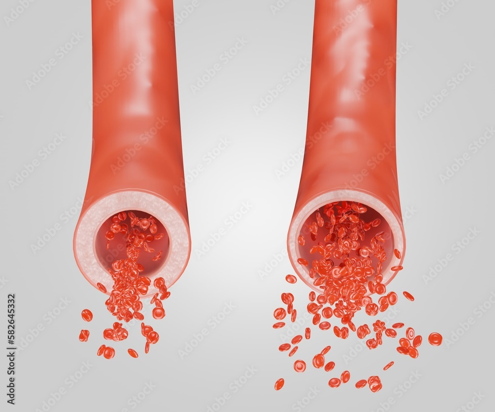 Póster normal blood vessel and widening blood vessels, Vasodilation ...