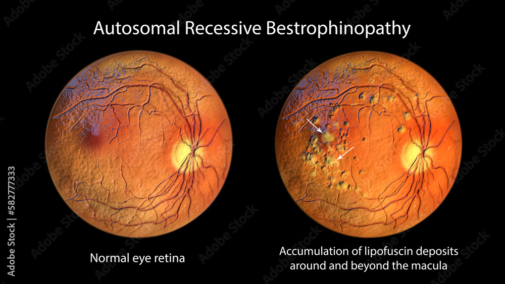 Autosomal recessive bestrophinopathy, 3D illustration showing normal ...