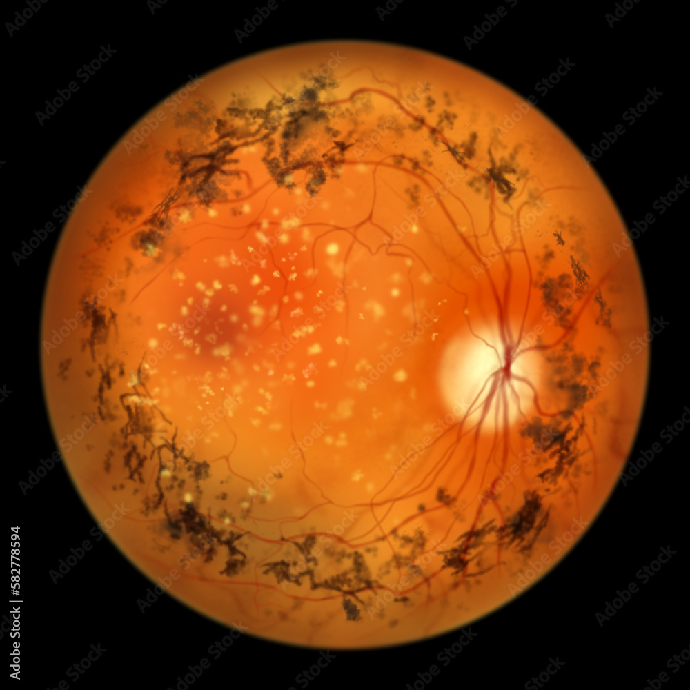 Poster Retinitis pigmentosa, a genetic eye disease leading to vision ...